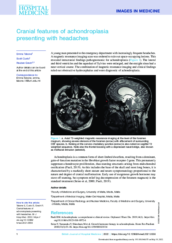 (PDF) Cranial features of achondroplasia presenting with headaches