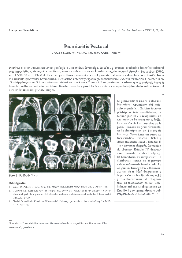 (PDF) Piomiositis pectoral