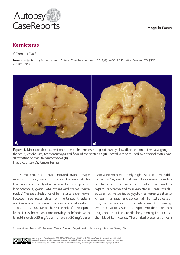 (PDF) Kernicterus