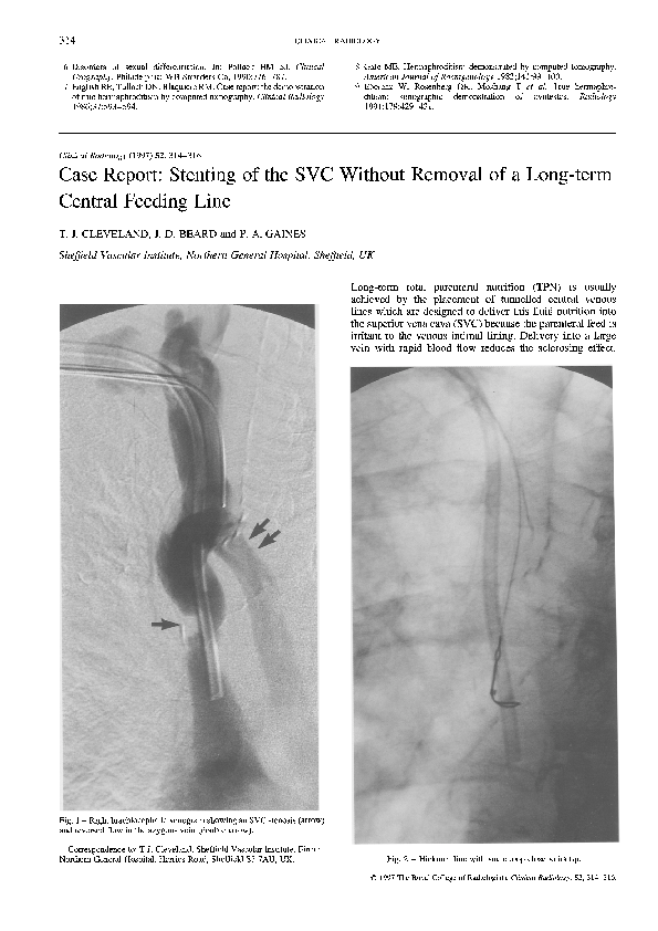 (PDF) Case report: Stenting of the SVC without removal of a long-term ...