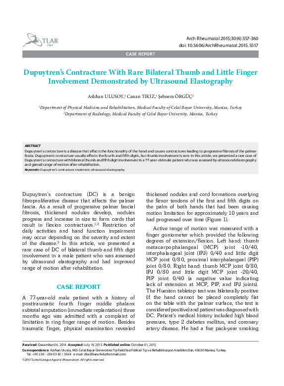 (PDF) Dupuytren’s Contracture With Rare Bilateral Thumb and Little ...