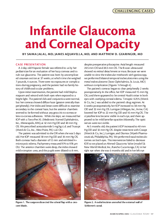 (PDF) Infantile Glaucoma and Corneal Opacity