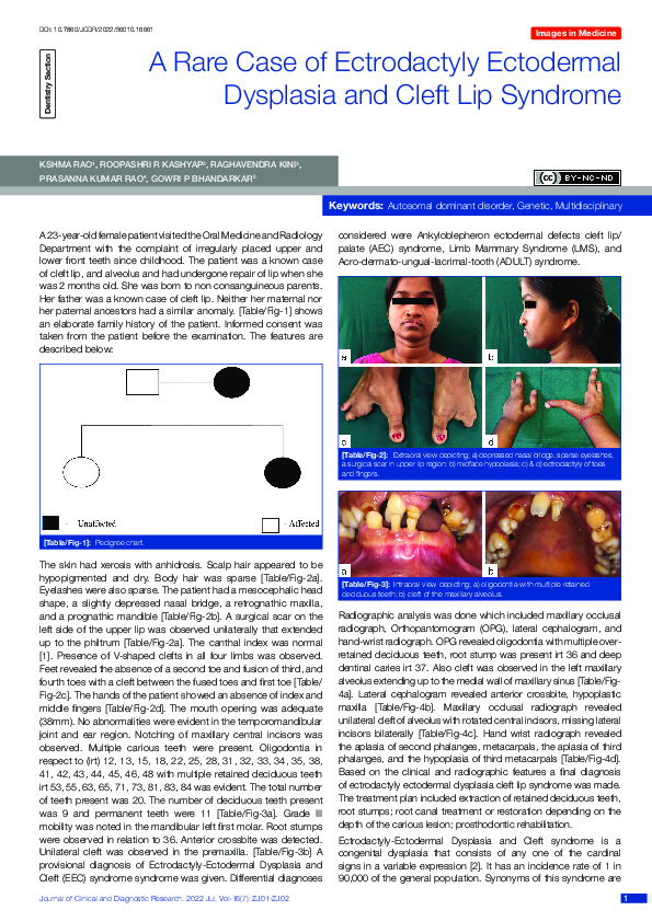 Pdf A Rare Case Of Ectrodactyly Ectodermal Dysplasia And Cleft Lip Syndrome Kshma Rao