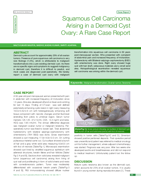 (PDF) Squamous Cell Carcinoma Arising in a Dermoid Cyst Ovary: A Rare Case Report