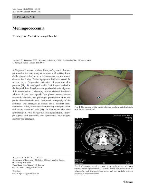 (PDF) Meningococcemia