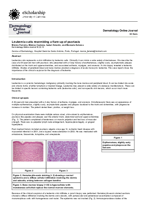 (PDF) Leukemia cutis resembling a flare-up of psoriasis