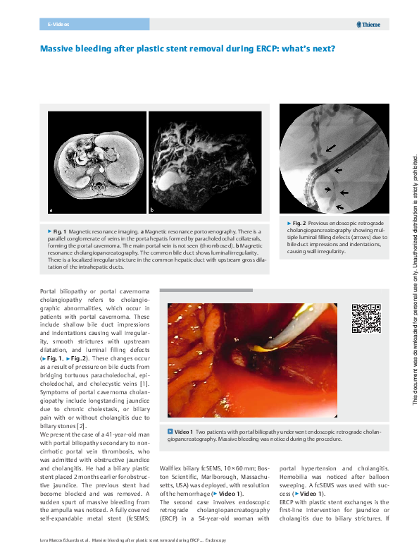 (PDF) Massive bleeding after plastic stent removal during ERCP: what’s ...