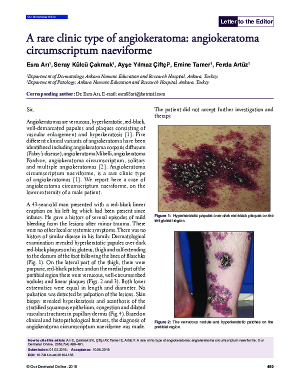 (PDF) A rare clinic type of angiokeratoma: angiokeratoma circumscriptum ...