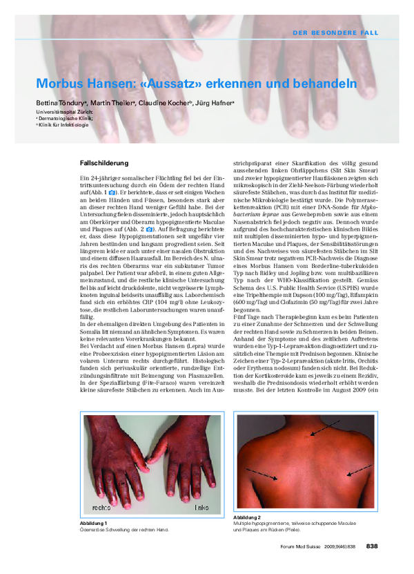 (PDF) Morbus Hansen: «Aussatz» erkennen und behandeln | Claudine Kocher ...