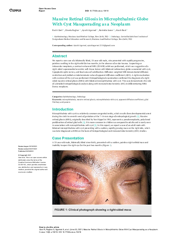 (PDF) Massive Retinal Gliosis in Microphthalmic Globe With Cyst ...