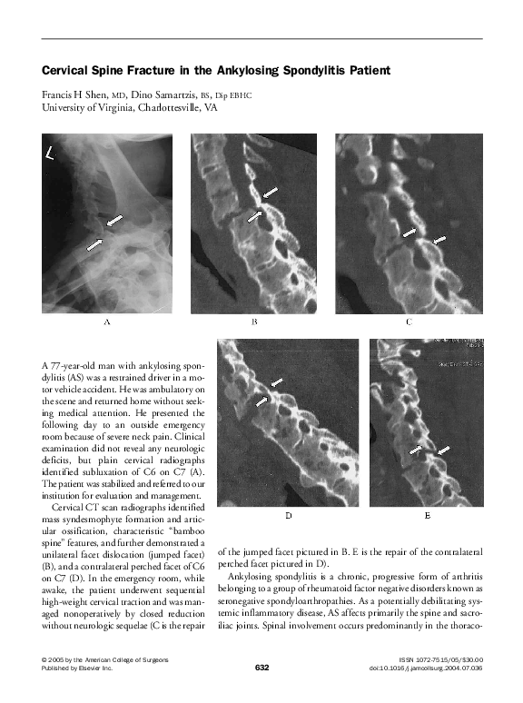 (PDF) Cervical spine fracture in the ankylosing spondylitis patient