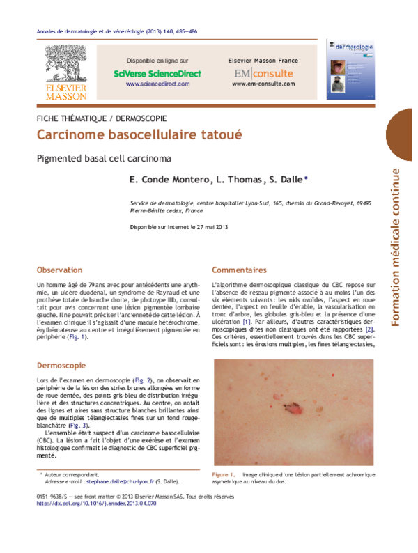 (PDF) Carcinome basocellulaire tatoué