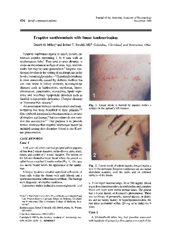 (PDF) Eruptive xanthomatosis with linear koebnerization