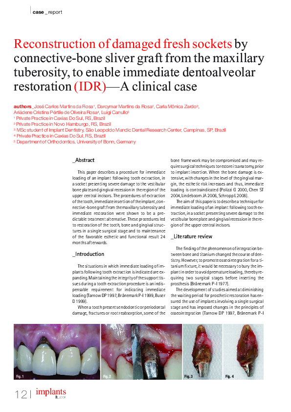 (PDF) Reconstruction of damaged fresh sockets by connective-bone sliver graft from the maxillary ...
