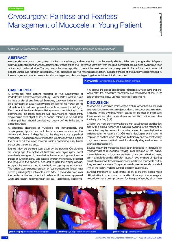 (PDF) Cryosurgery: Painless and Fearless Management of Mucocele in ...