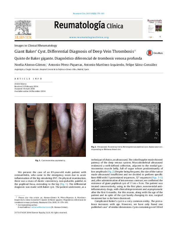 (PDF) Quiste de Baker gigante. Diagnóstico diferencial de trombosis venosa profunda