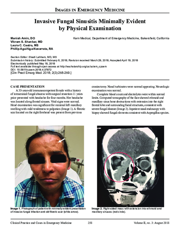 (PDF) Invasive Fungal Sinusitis Minimally Evident by Physical Examination