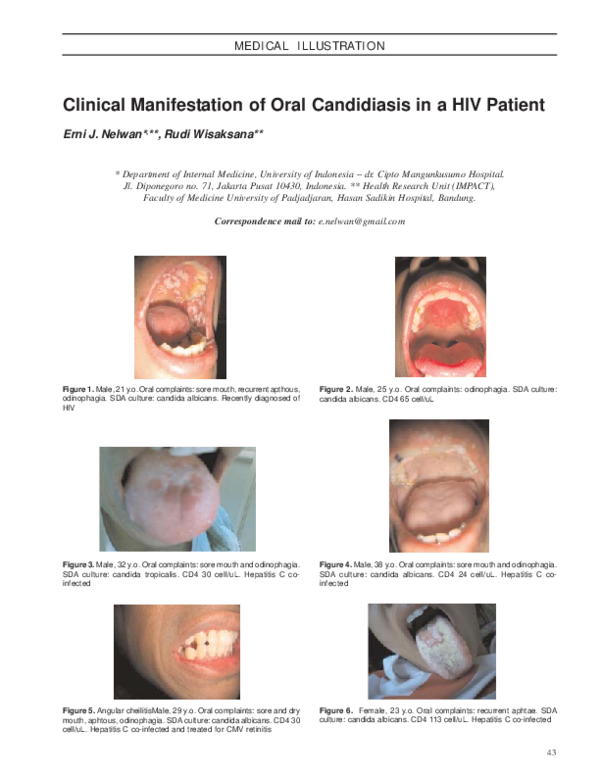 (PDF) Clinical manifestation of oral candidiasis in a HIV patient