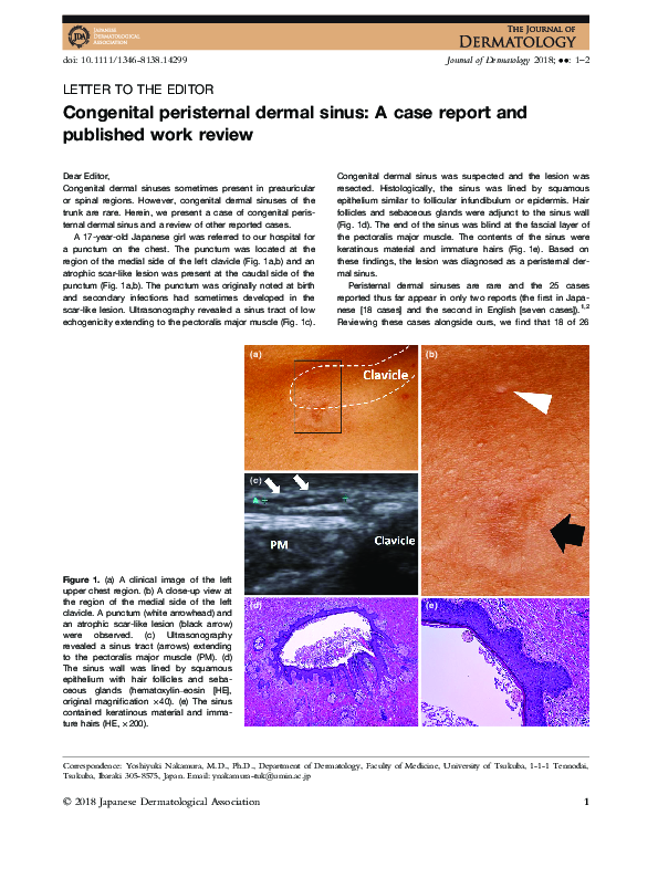 (PDF) Congenital peristernal dermal sinus: A case report and published ...