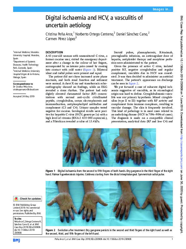 (PDF) Digital ischaemia and HCV, a vasculitis of uncertain aetiology