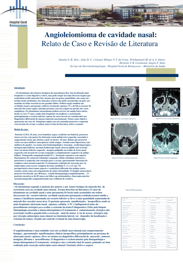 (PDF) Angioleiomioma de cavidade nasal: relato de um caso e revisão de ...