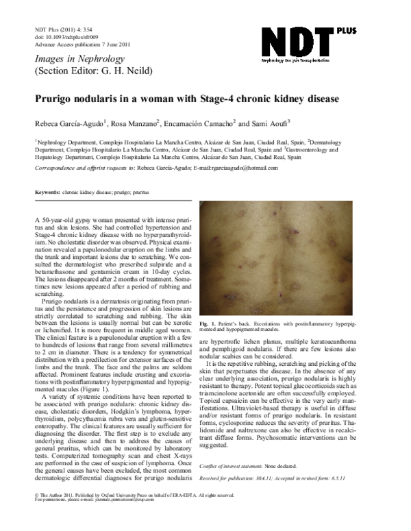 (PDF) Prurigo nodularis in a woman with Stage-4 chronic kidney disease