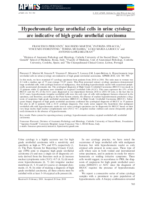 PDF Hypochromatic Large Urothelial Cells In Urine Cytology Are pdf-hypochromatic-large-urothelial-cells-in-urine-cytology-are