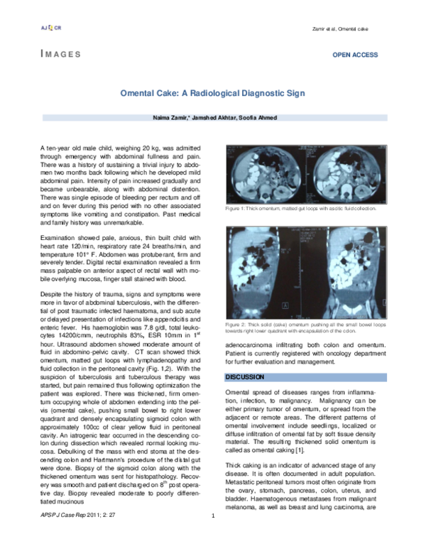 (PDF) Omental cake: a radiological diagnostic sign