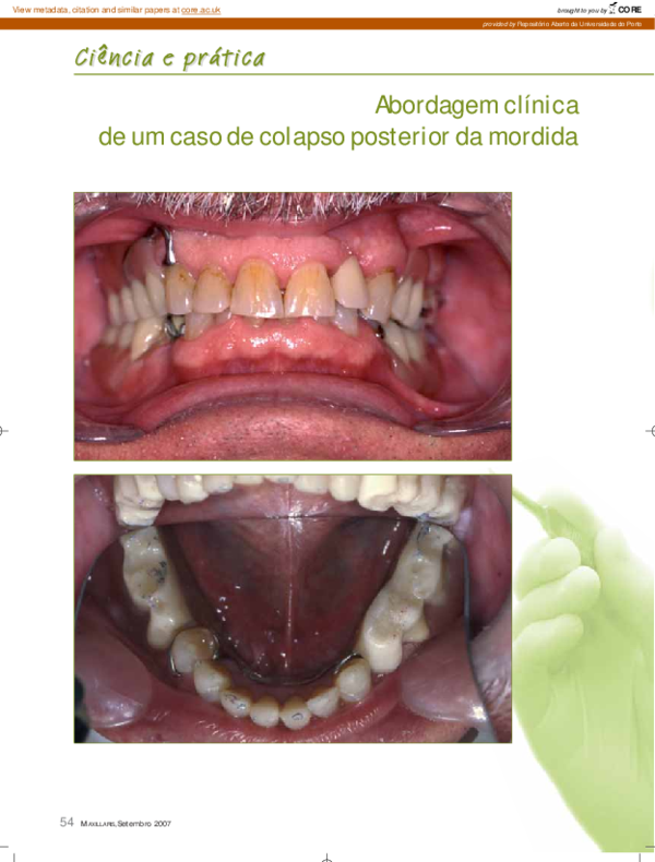 (PDF) Abordagem clínica de um caso de colapso posterior da mordida