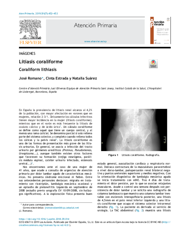 (PDF) Litiasis coraliforme
