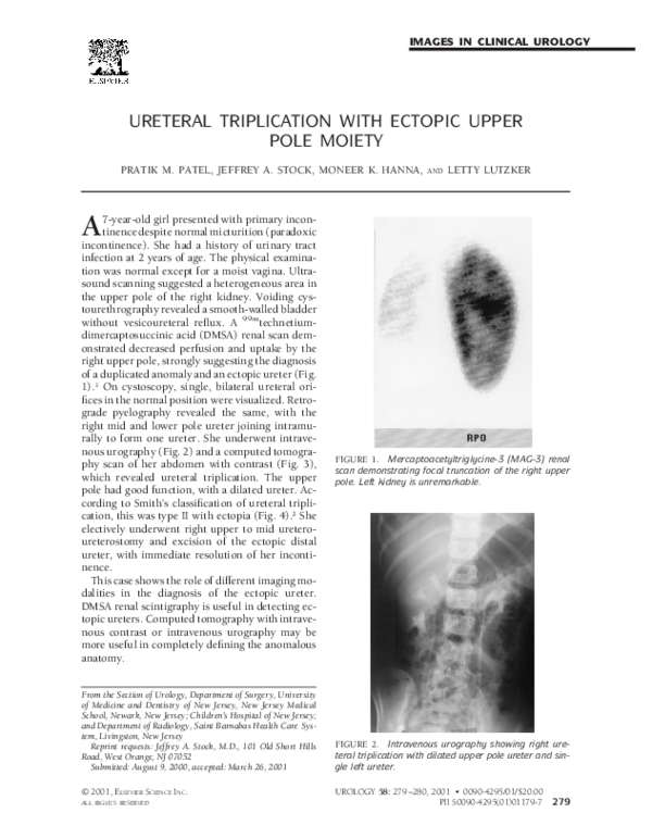 (PDF) Ureteral triplication with ectopic upper pole moiety | Jeffrey ...