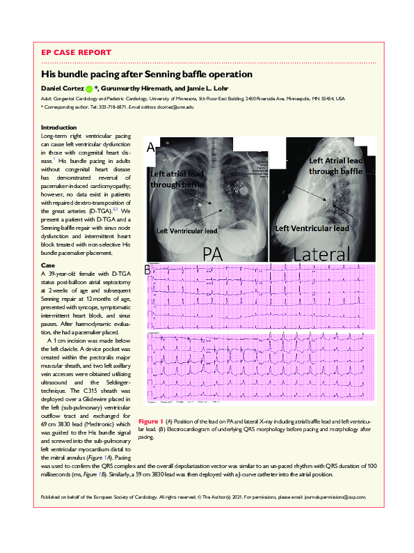 (PDF) His bundle pacing after Senning baffle operation