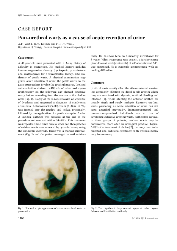 (PDF) Pan-urethral warts as a cause of acute retention of urine ...