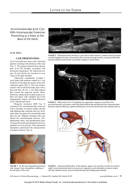 Pdf Acromioclavicular Joint Cyst With Intramuscular Extension