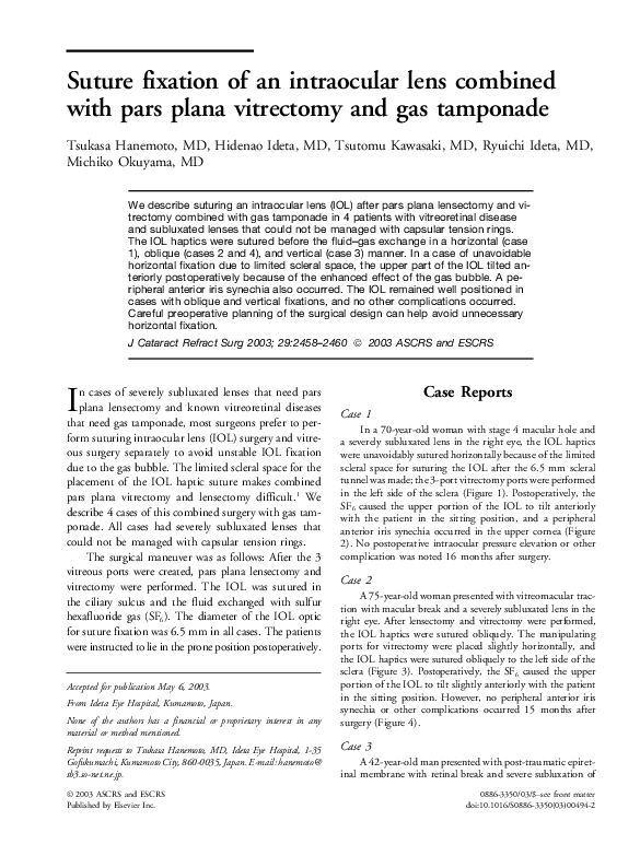 (PDF) Suture fixation of an intraocular lens combined with pars plana ...