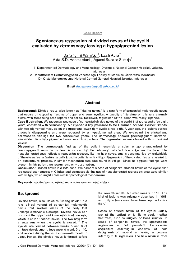 (PDF) Spontaneous Regression of Eyelid Divided Nevus