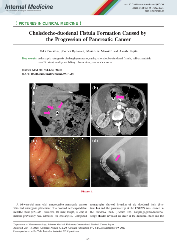 (PDF) Choledocho-duodenal Fistula Formation Caused by the Progression ...