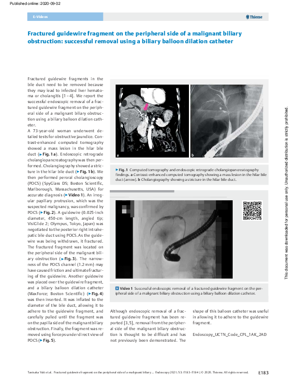 (PDF) Fractured guidewire fragment on the peripheral side of a ...