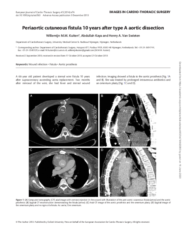 (PDF) Periaortic cutaneous fistula 10 years after type A aortic dissection