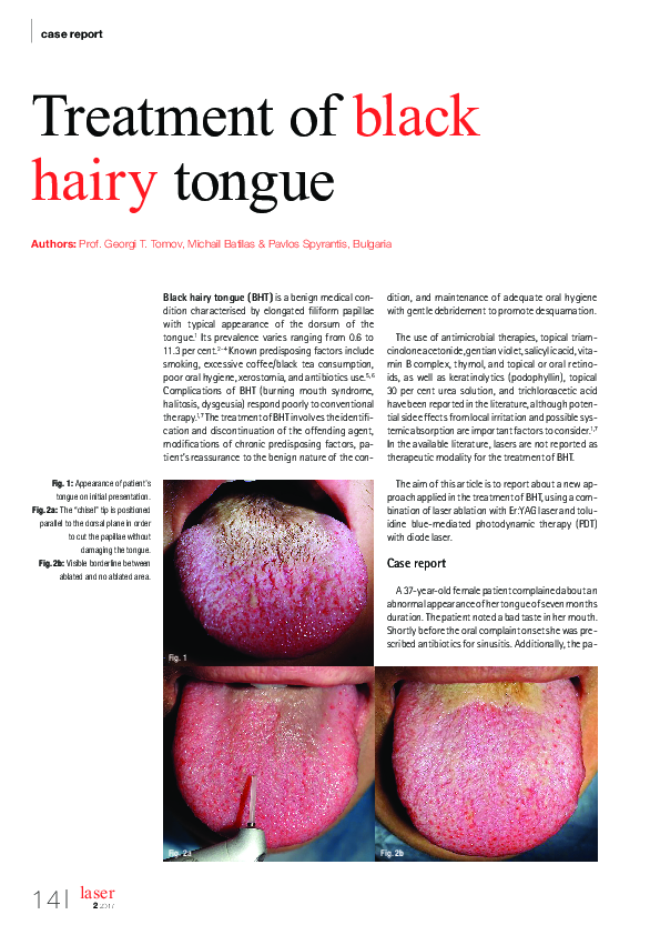 (PDF) [Treatment of "Black Hairy Tongue"]