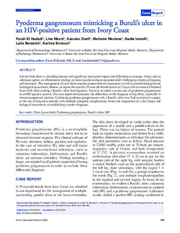 (PDF) Pyoderma gangrenosum mimicking a Buruli’s ulcer in an HIV-positive patient from Ivory Coast