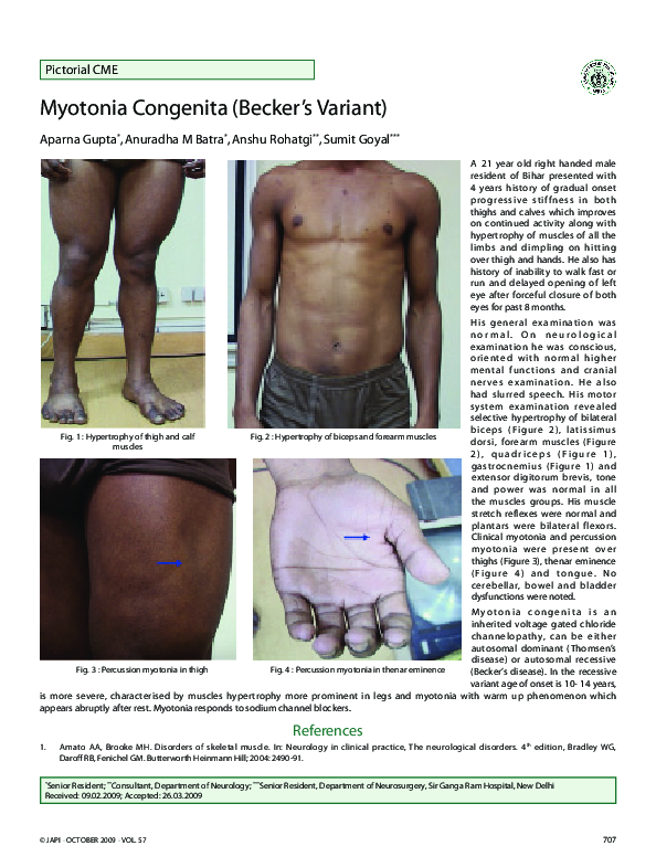 (PDF) Myotonia congenita (Becker's variant)