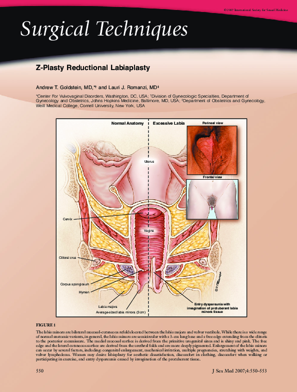 (PDF) Z-Plasty Reductional Labiaplasty