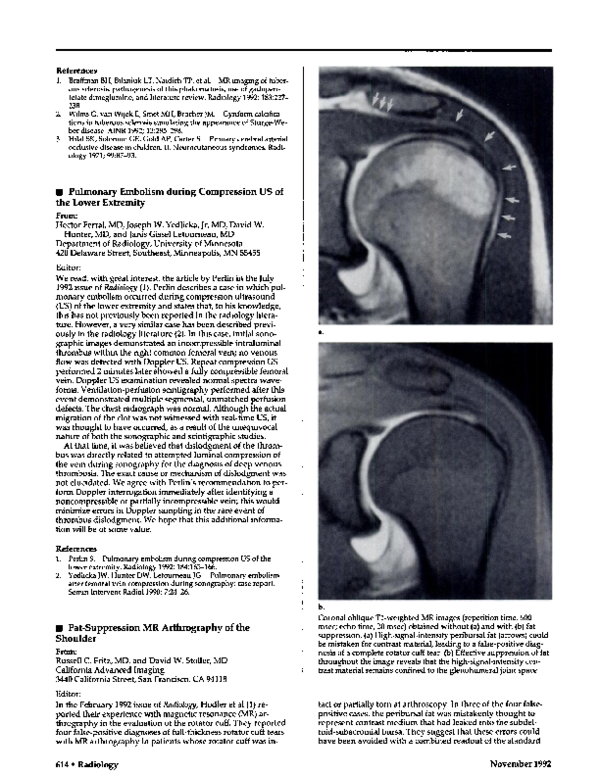 (PDF) Pulmonary embolism during compression US of the lower extremity