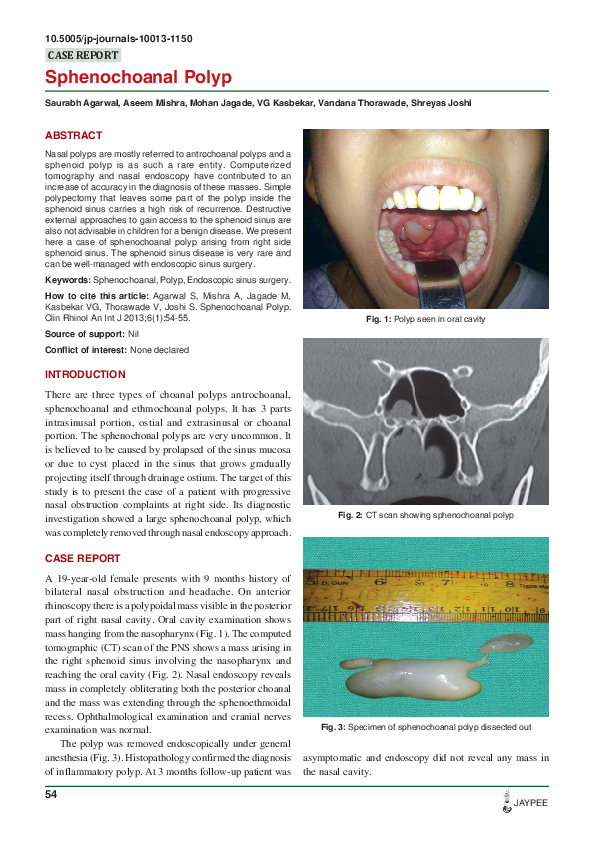 (PDF) Sphenochoanal Polyp | Aseem Mishra - Academia.edu