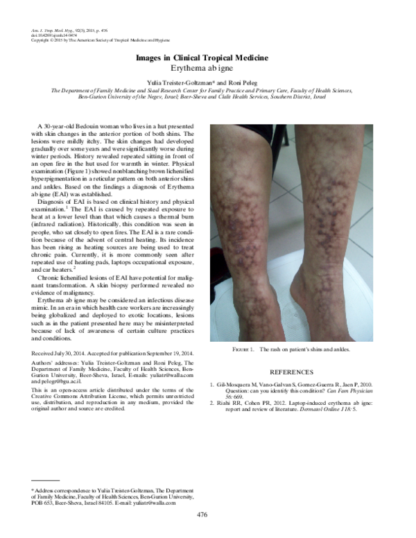 (PDF) Erythema Ab Igne