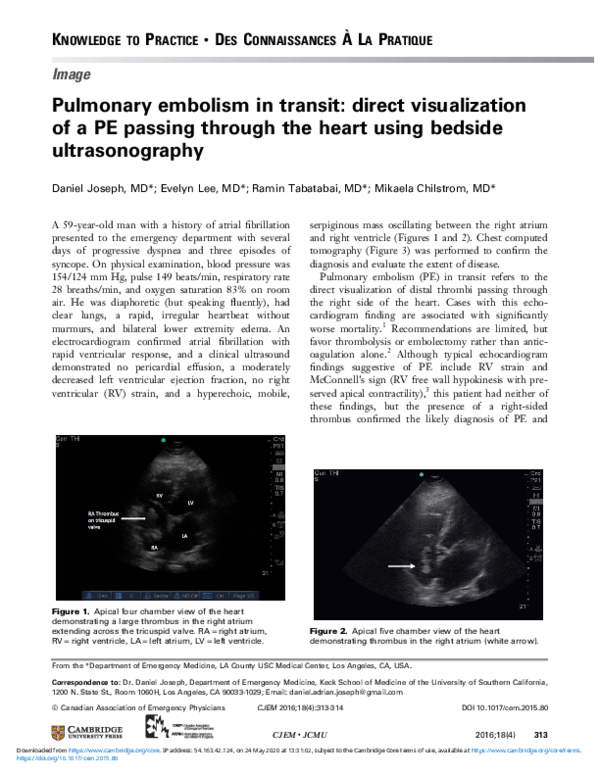 (PDF) Pulmonary embolism in transit: direct visualization of a PE ...