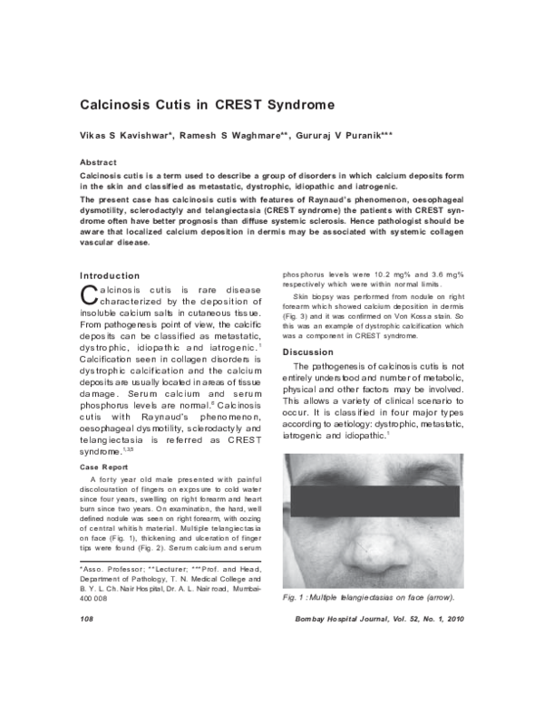 (PDF) Calcinosis Cutis in CREST Syndrome