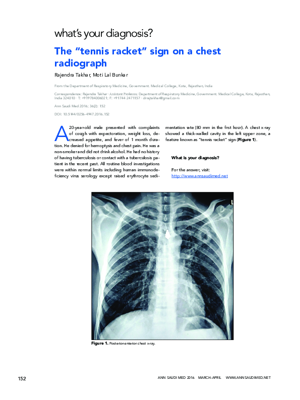 (PDF) The “tennis racket” sign on a chest radiograph | Moti Bunkar ...
