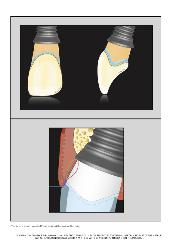 (PDF) Considerations of implant abutment and crown contour: critical ...